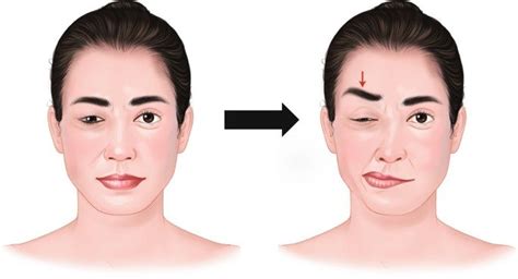 Hemifacial Spasm Dr Vivek Agrawal