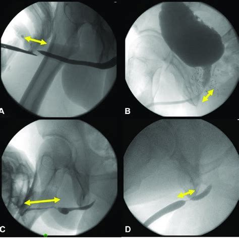 The Authors Treatment Algorithm For Recurrent Stricture Based On