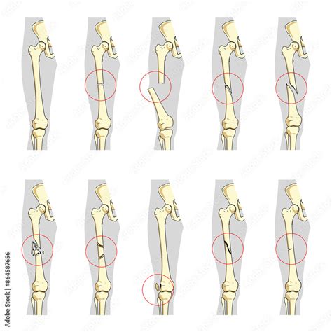 Types Of Bone Fractures Medical Skeleton Anatomy Educational Png