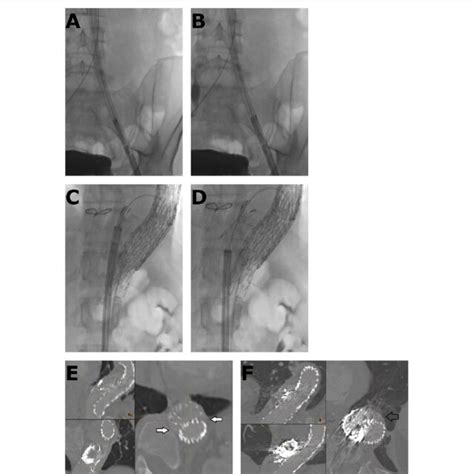 Pdf A Modified Candy Plug Technique To Occlude False Lumen In Aortic Dissection