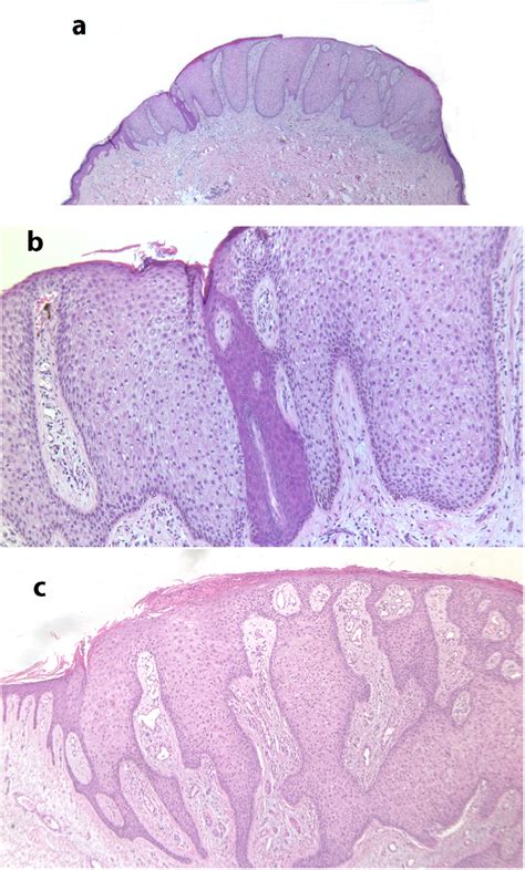 Translated Article Clear Cell Acanthoma A Series Of 70 Cases Actas Dermo Sifiliográficas