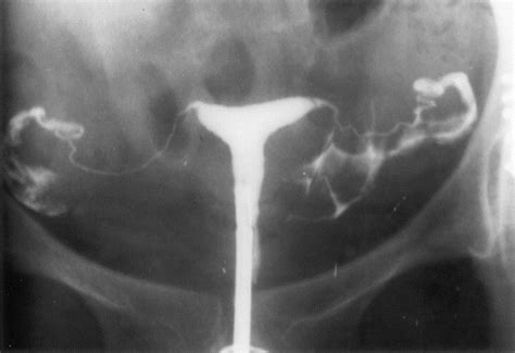 Hysterosalpingography Fertility And Sterility