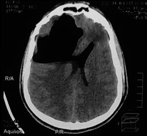 Surgical Neurology International