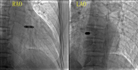 Typical Image Of The Leadless Pacemaker Implanted In The High Download Scientific Diagram