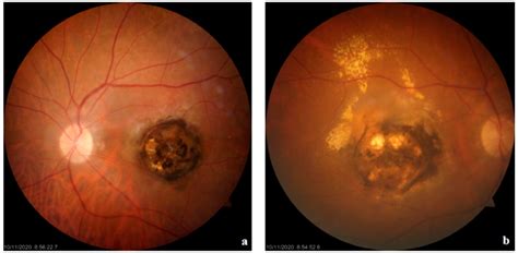 Ocular Toxoplasmosis Advances In Toxoplasma Gondii Biology Clinical