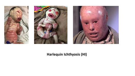 Ichthyoses Ppt