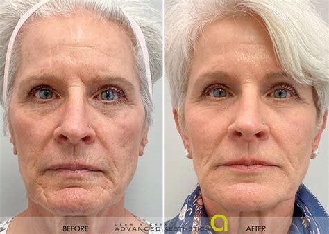 Radiesse Marionette Lines Before After Radiesse Marionette Lines Before After