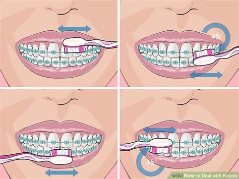 3 Ways To Deal With Braces Wikihow