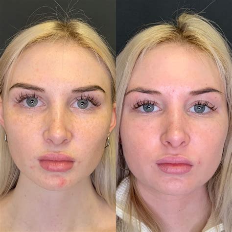 Aftercare Prp Facial At George Cho Blog