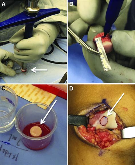 A The Osteochondral Autograft Transfer System Harvester Is Placed
