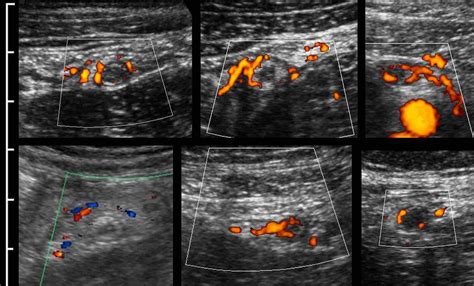 The Radiology Assistant Appendicitis Us Findings