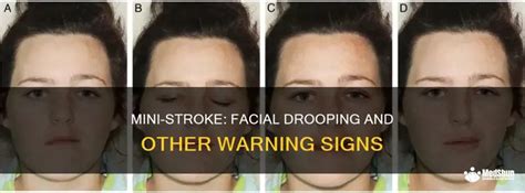 Mini Stroke Facial Drooping And Other Warning Signs Medshun