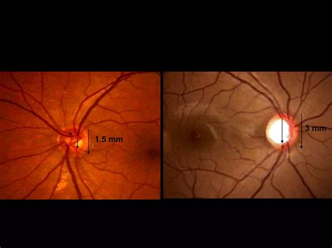 22 Optic Disc Evaluation In Glaucoma Ppt