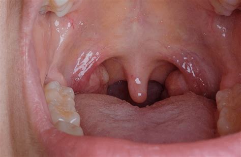 Tonsil Stone Or Cyst Rmedical