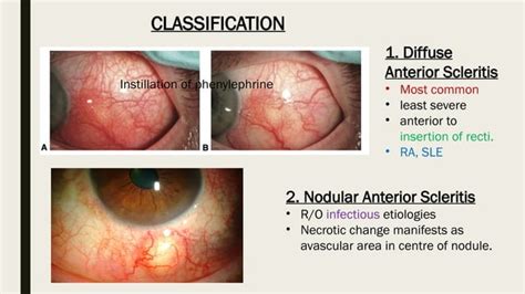 Episcleritis And Scleritis Causes Clinical Features Treatmentpptx