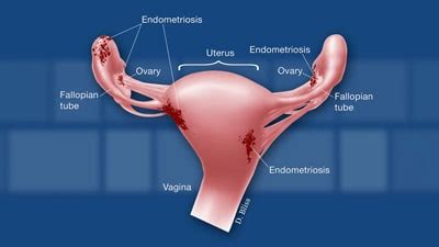 Gynecology Endometriosis Treatment Fort Myers And Naples