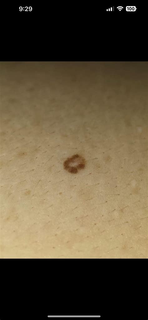 Moles R Dermatologyquestions