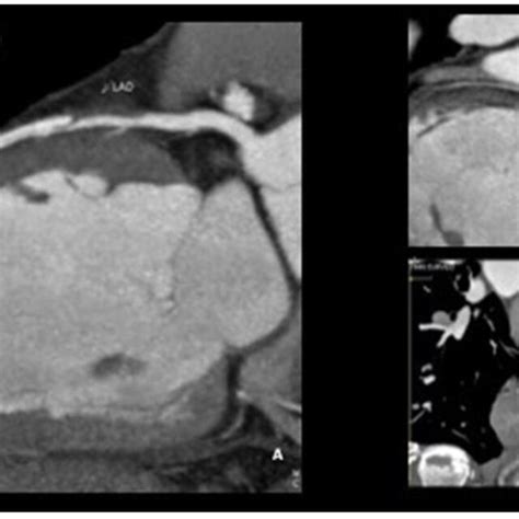 Coronary Ct Of A 42 Year Old Woman With Stemi Showing Scad Of The