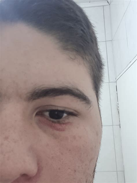 Had Sex With A Hooker And Now Got A Rash In My Eye Raskdocs