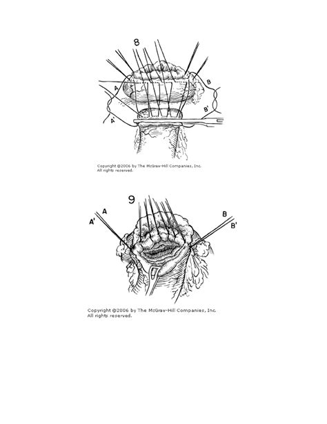 Hemigastrectomy Billroth I Method Doc