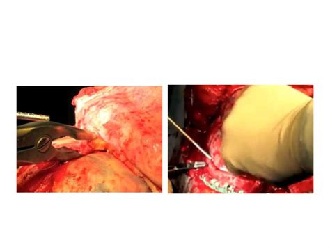 Decompressive Craniectomy Dr Shameej Ppt