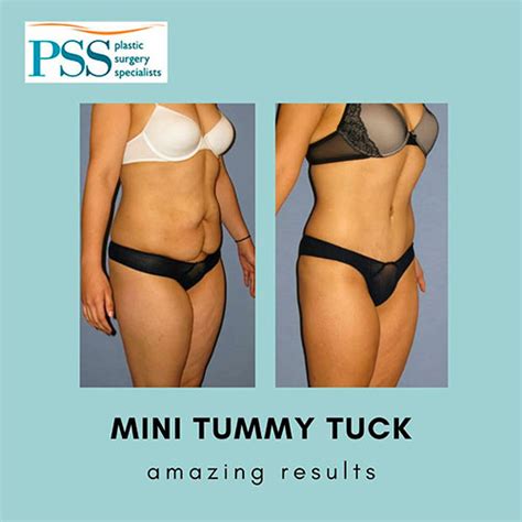 Mini Tummy Tuck Before And After Real Patient Results