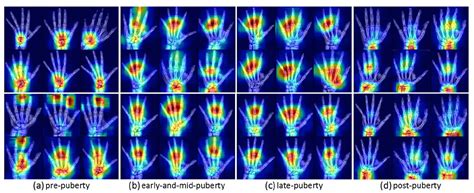 bone age assessment with artificial intelligence lab of medical imaging and computation