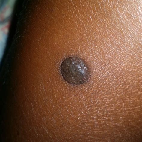 Getting Rid Of Seed Warts Thriftyfun