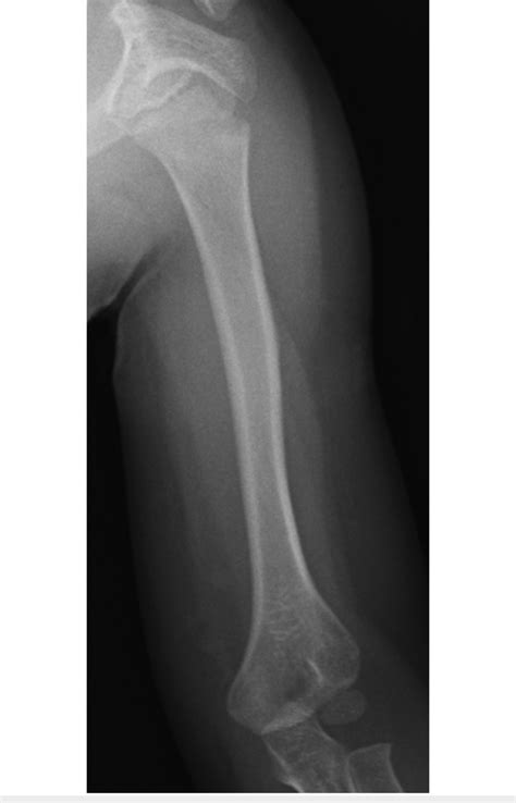 Anteroposterior Radiograph Of The Left Humerus Taken 36 Months After Download Scientific