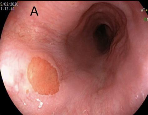 Esophageal Inlet Patch Endoscopic Prevalence In Full Sedated Patients And Clinical Significance