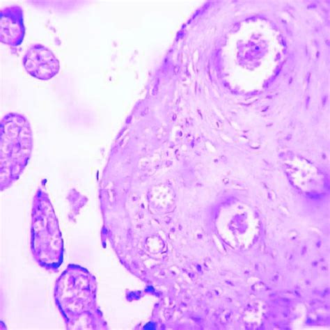 Decidual Chorionic Pseudocysts With Laminar Fibrinoid Necrosis He