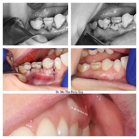 Perio Plastic On Retained Primary Tooth Connective Tissue Graft Flap