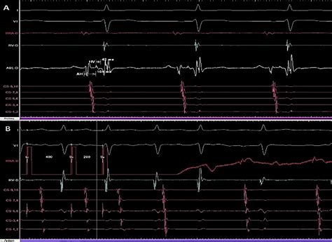A Normal Baseline Intracardiac Intervals Atrial His Bundle Ah