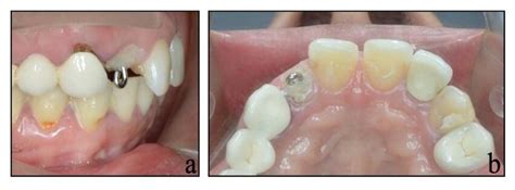 J Hook Placement By Removing Adequate Amount Of Rc Material Download