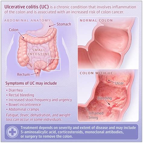 ¿qué Es La Colitis Ulcerosa Síntomas Diagnóstico Tratamiento Y