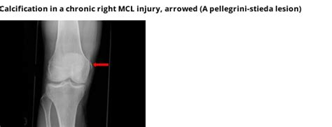 Complex Ligament Injuries Mclpcl Surgeons And Consultants Yorkshire