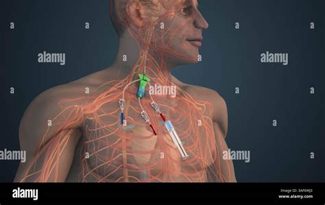 Recombinant Tissue Plasminogen Activator In Stroke Treatment Stock