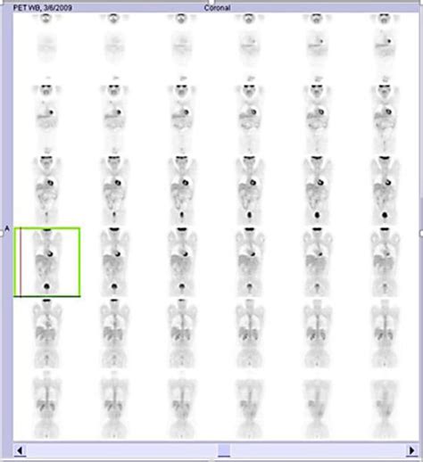 Case 3 Physiological Distribution Of Fdg Shown On Pet Without Any