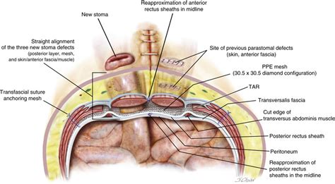 Surgical Management Of Parastomal Hernias Surgical Clinics