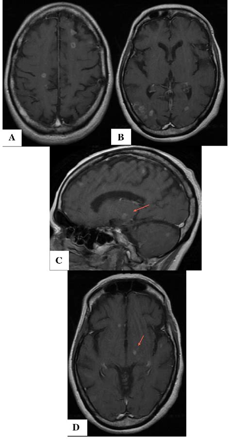 Contrast Enhanced T1 Weighted Brain Mri Scans Showing A Two Left