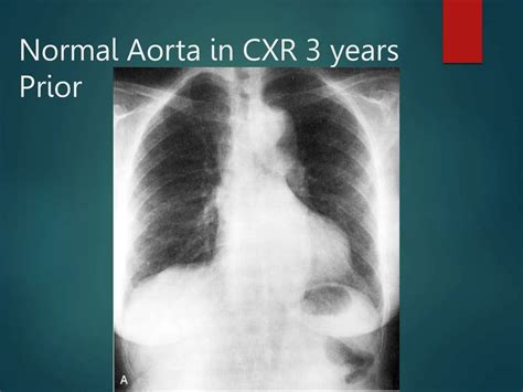 Aortic Dissection And Management Of Aortic Dissection Pptx