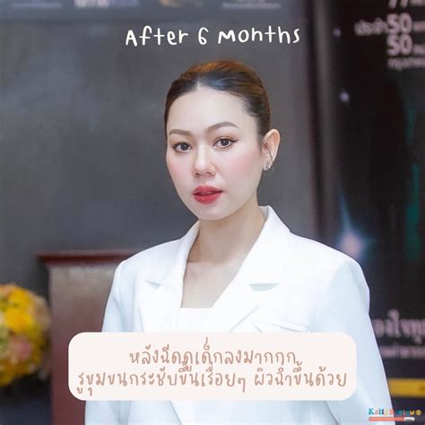 Neauvia ฟิลเลอร์เสริมชั้นผิว รูขุมขนกระชับกว่าเดิม First Clinic