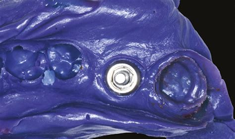 Matériaux à Empreinte élastique Polyéther Et Vinyl Polyether Siloxane