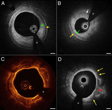 Fibrous And Fibrocalcific Plaques A Fibrous Plaque With Iem Green