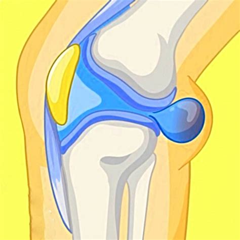Bakers Cyst The Back Of The Knee Bulge That Reveals More Oregon