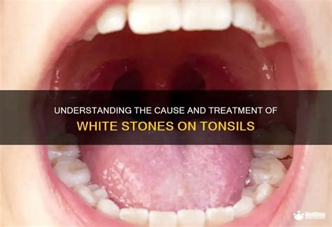Understanding The Cause And Treatment Of White Stones On Tonsils Medshun