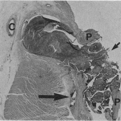 Egetation And Leaflet Perfora Fig 4 Annular Abscess In Patient 2 Tion Download Scientific