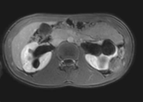 Liver Segmentation Roboflow Universe