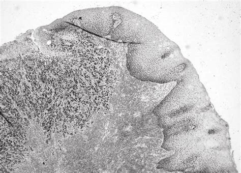 Undifferentiated Oral Squamous Cell Carcinoma Scc Of The Finnish
