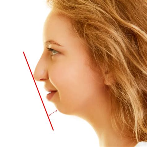 How Can You Tell If You Have A Recessed Chin